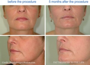 Are Fat Injections the Best For Lip Enhancement? - CandyLipz