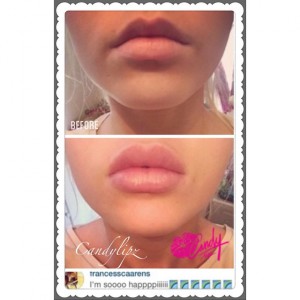 How to Reduce Drooping Mouth Corners - CandyLipz